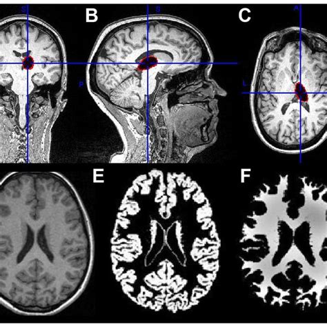 Examples Of Subcortical And Global Brain Segmentation An Example Of