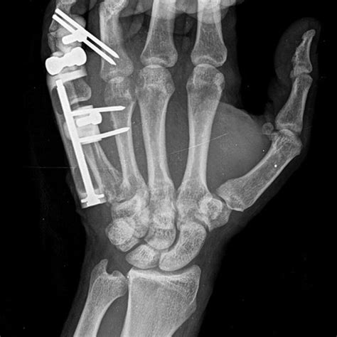 Stabilization Of The Mcp Joint With External Fixator After Combined Download Scientific Diagram