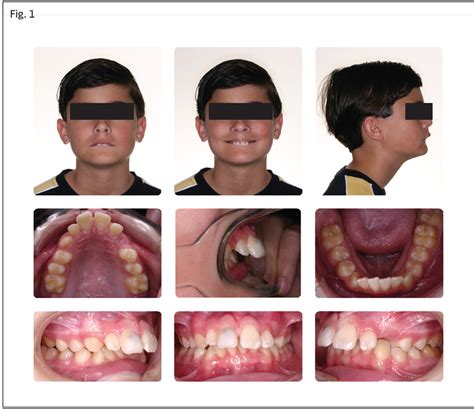 Herbst Fixed Functional Treatment For A Severe Class Ii By Dr William