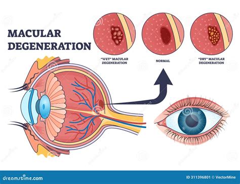 Macular Degeneration As Eye Illness And Eyesight Problem Outline