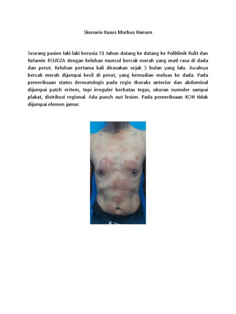 Skenario Kasus Morbus Hansen Pdf