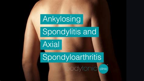 Ankylosing Spondylitis Bodytonic Clinic