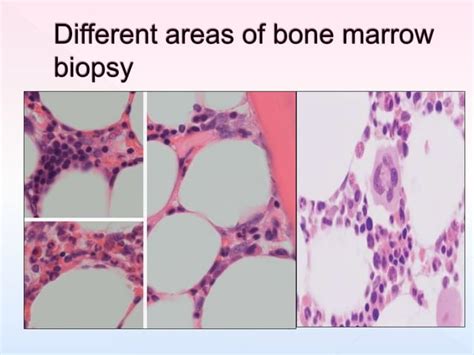 Processing Of Bone Marrow Trephine Biopsy Ppt