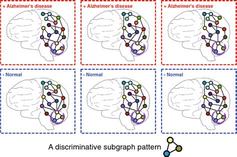 an example of discriminative subgraph patterns in brain networks
