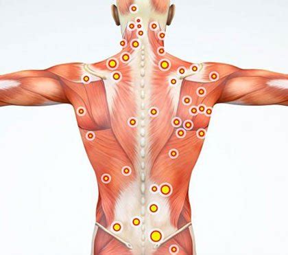 Trigger Point Injections Specialists In NYC