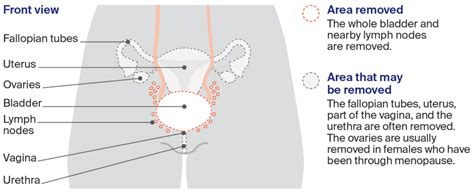Cystectomy For Bladder Cancer Cancer Council Nsw
