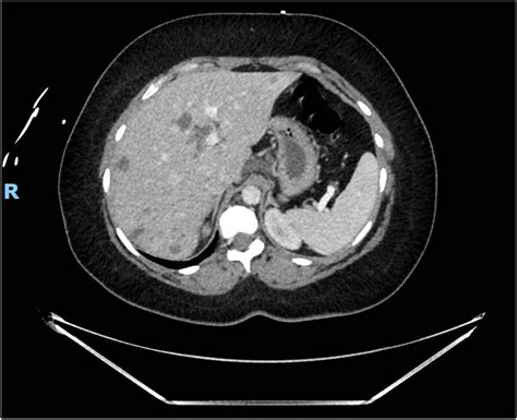 Ct Scan Demonstrating Multiple Hepatic Hypodensities Download