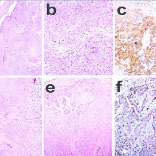 Figure1 The Clinical Views Of The Nodular And Ulcerous Lesions Download Scientific Diagram