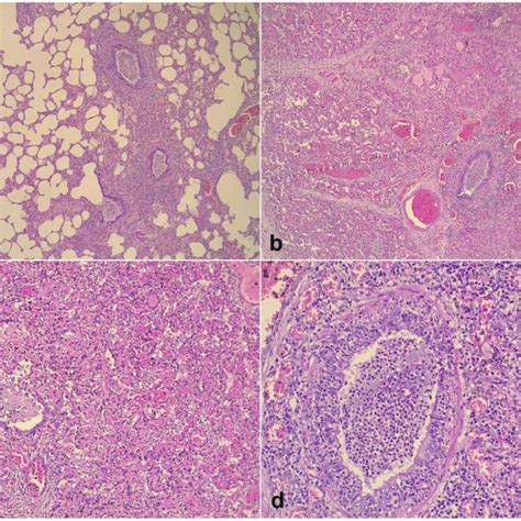 A Lymph Node With Marked Vascular Congestion And Lymphocyte Depletion