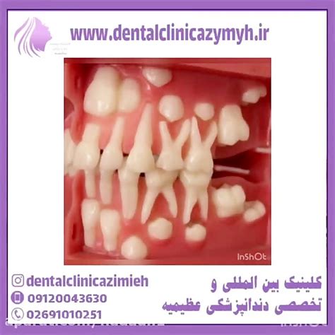 از چه سنی دندان های شیری شروع به افتادن می کنند؟