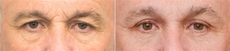 Eyelid Skin Cancer Surgery Chicago Oculofacial Consultants
