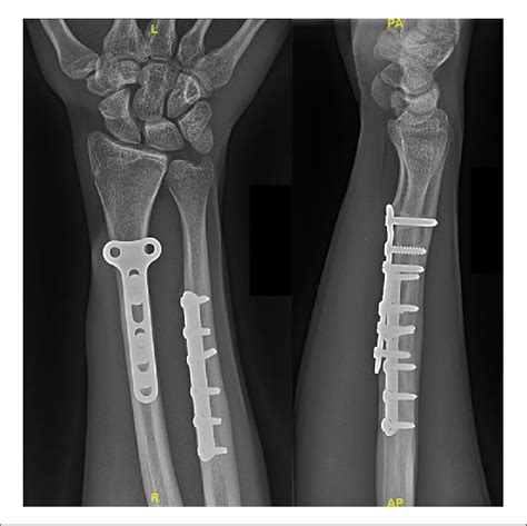 Radiographs At 4 Years Postoperatively 17 Years Old Demonstrated