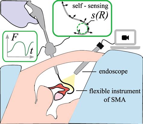 Vision Of A Minimally Invasive Surgery Mis With A Flexible Instrument Download Scientific