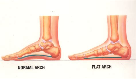 Custom Orthotics For Flat Feet Pes Planus Abundant Life Health