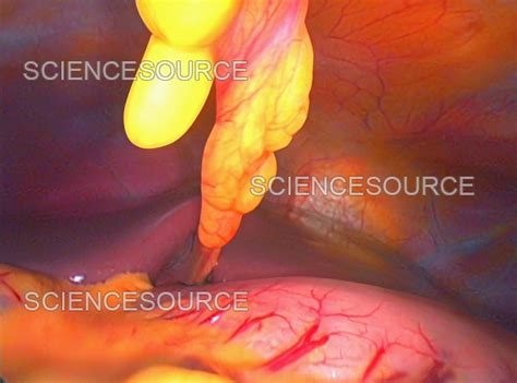 Healthy Abdomen Laparoscopic View Stock Image Science Source Images