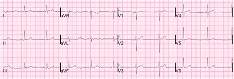 Dr Smiths Ecg Blog Dynamic Reversible Ischemic T Wave Inversion Mimics Wellens All Trops