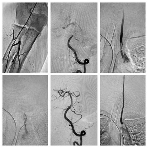 Kalyan Sajja On Linkedin 25 Year Old Guy With Basilar Symptoms And