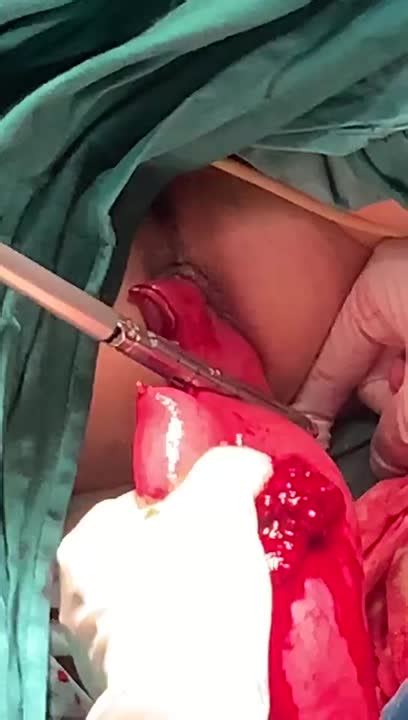 Miconvey Technologies Coltd On Linkedin Endoscopic Linear Cutting