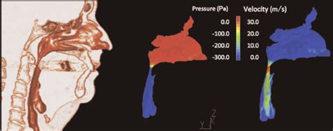 Computational Fluid Dynamics Airway Modeling Before Maxillomandibular Download Scientific