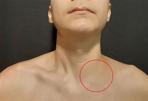 Sternocleidomastoid Muscle Swelling