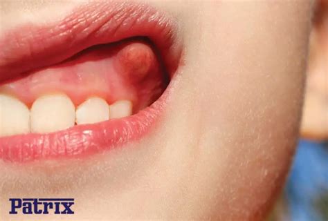 آبسه دندان چیست؟ علل و روش‌های درمان این مشکل علائم