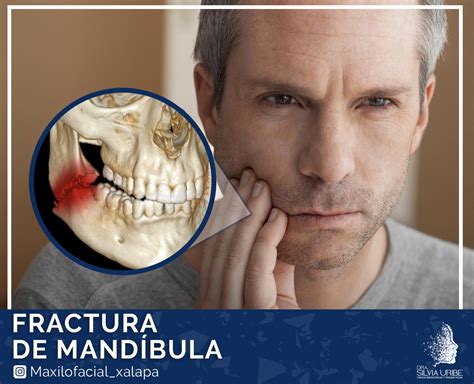 La Fractura Del Maxilar Inferior Maxilofacial Xalapa