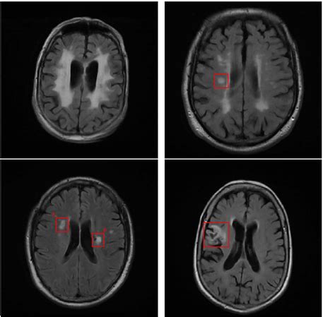 Figure 1 From Brain Lesion Segmentation Through Image Synthesis And Outlier Detection Semantic