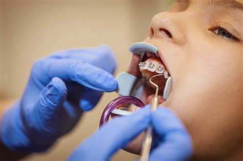 La goma de los brackets qué función tiene Álvaro y Franco Clínica dental en Torrelodones