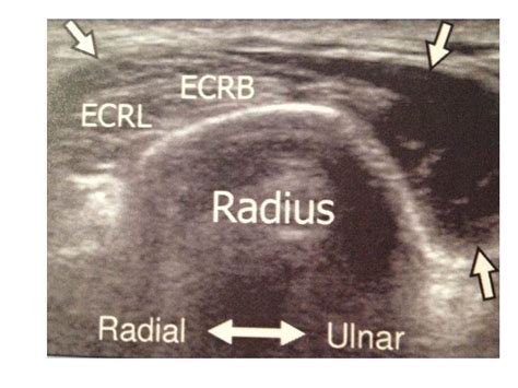 Intersection Syndrome A Cause Of Forearm Pain Stemcelldocs Weblog