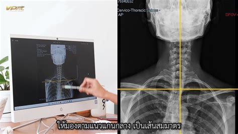 ใครที่มีปัญหากระดูสันหลังคด และอยากหายโดยไม่ต้องผ่าตัด พร้อมทั้งกับมี