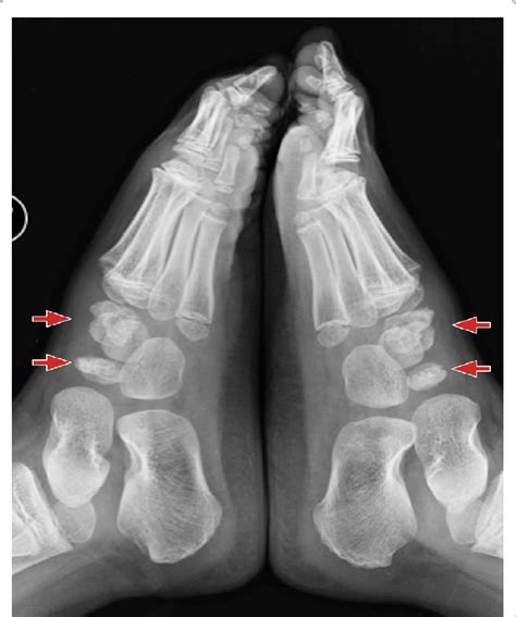 Lateral Cuneiform Bone
