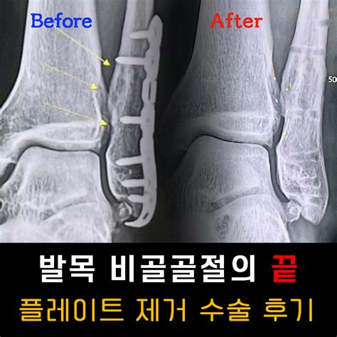 발목 비골 골절 1년 후 [플레이트 제거 수술] 네이버 블로그