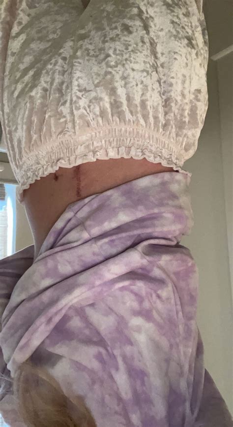 Tethered Cord Release Sydney Severance