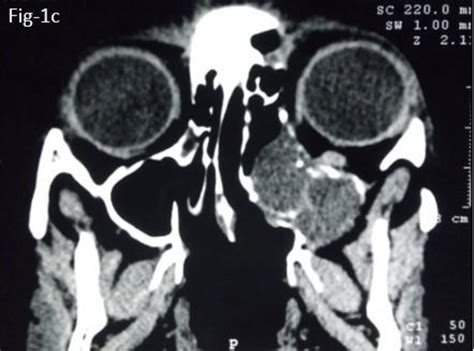 C Cect Showing No Significant Enhancement In Well Defined Lobulated
