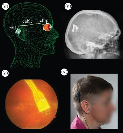 Retinal Prosthesis Switchboard Visionresearch4you