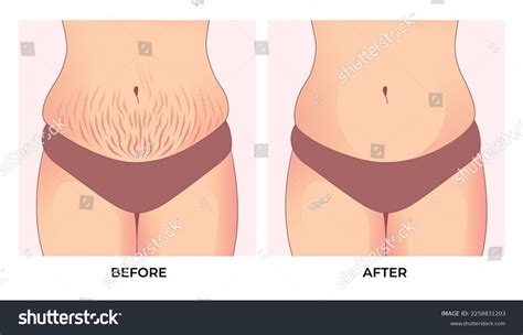 Belly Fat Before After Weight Loss Stock Vector Royalty Free