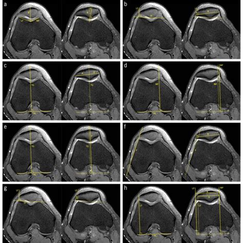 Fat Saturated Proton Density Weighted Magnetic Resonance Images