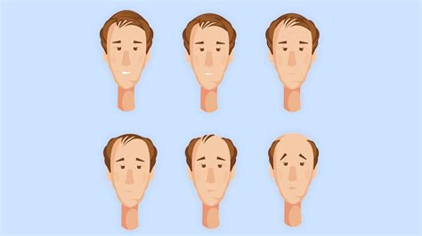 Receding Hairline Stages Diagnosis And Treatment Options Onlymyhealth