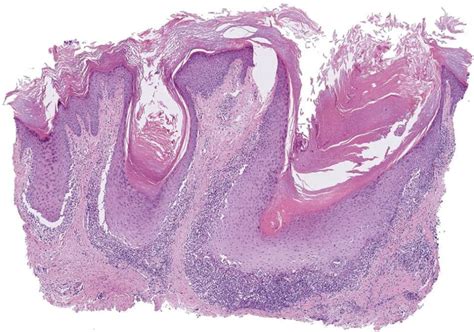 Lichen Planus Obgyn Key