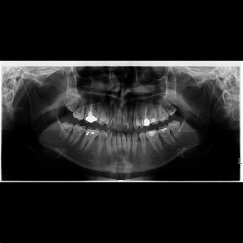 Dental Caries Panaromic X Rays Object Detection Dataset And Pre Trained Model By Cariesdetection