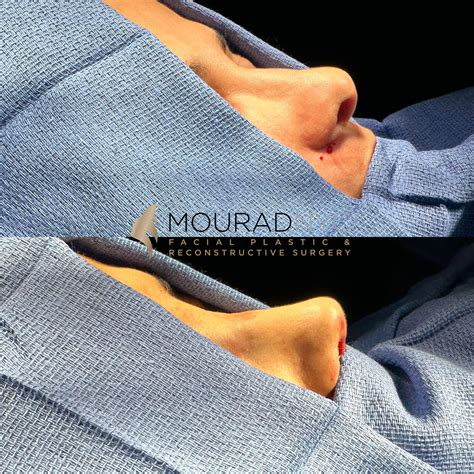 Nasal Valve Collapse Mourad Md Facial Plastic Surgeon Symptoms