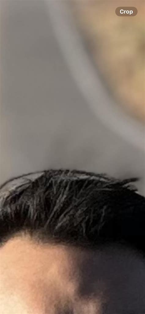 Bump On Forehead Rdiagnoseme