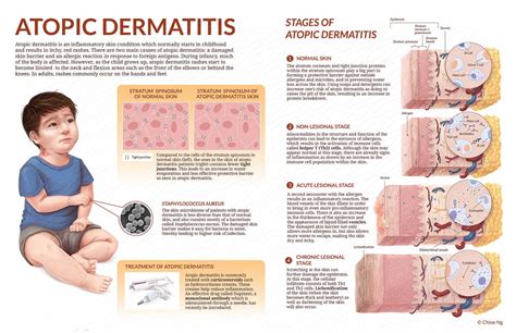 Pathogenesis Of Atopic Dermatitis Ami Meeting 2020