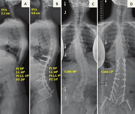 Representative Preoperative A And C And Postoperative B And D