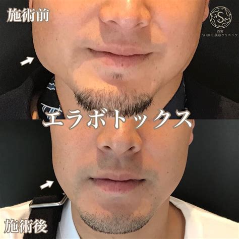 エラボトックス エラ・小顔ボトックスの症例 Kobe美容皮膚科 Cs71464《美容医療の口コミ広場》