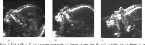 Nasal Bone Ultrasound