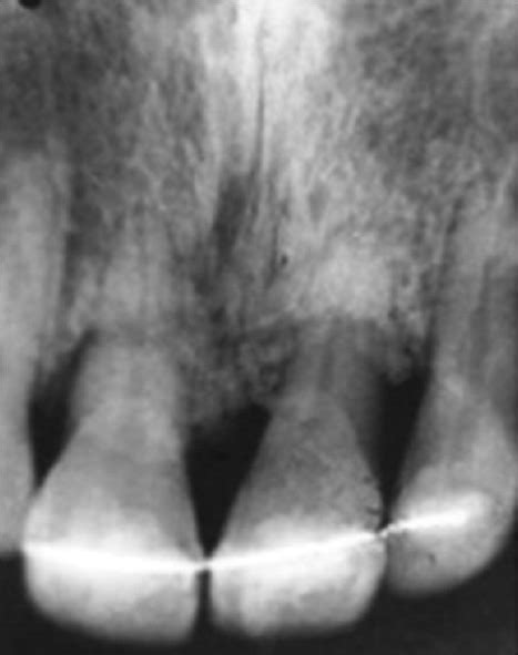 Post Operative Radiograph After 8 Years Download Scientific Diagram