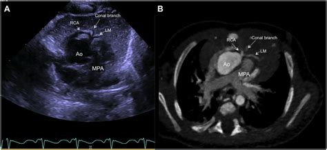Coronary Artery Arrangement In Patients With Tof Parasternal