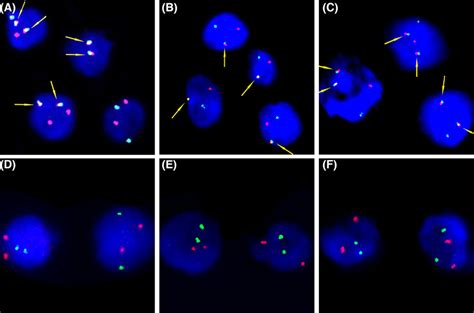 FISH Validation Of Fusion Genes Detected By RNA Sequencing RNAseq