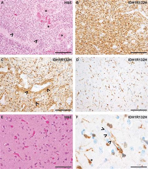 Histopathology Of Glioma Invasion Classical Features Of A Gbm Showing